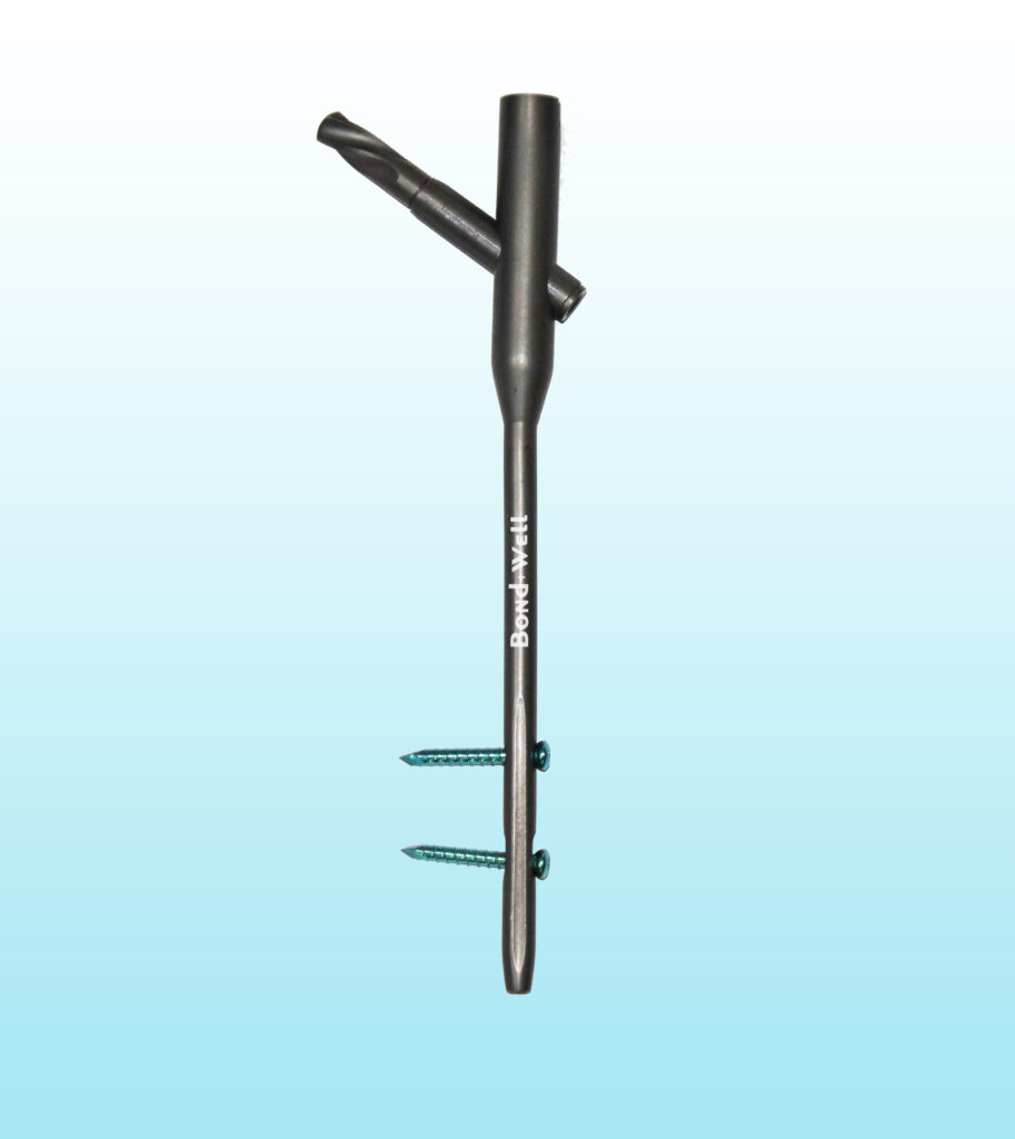 PFNA 2 Nail (Proximal Femur Antirotation Nail ) - Bond Well Ortho